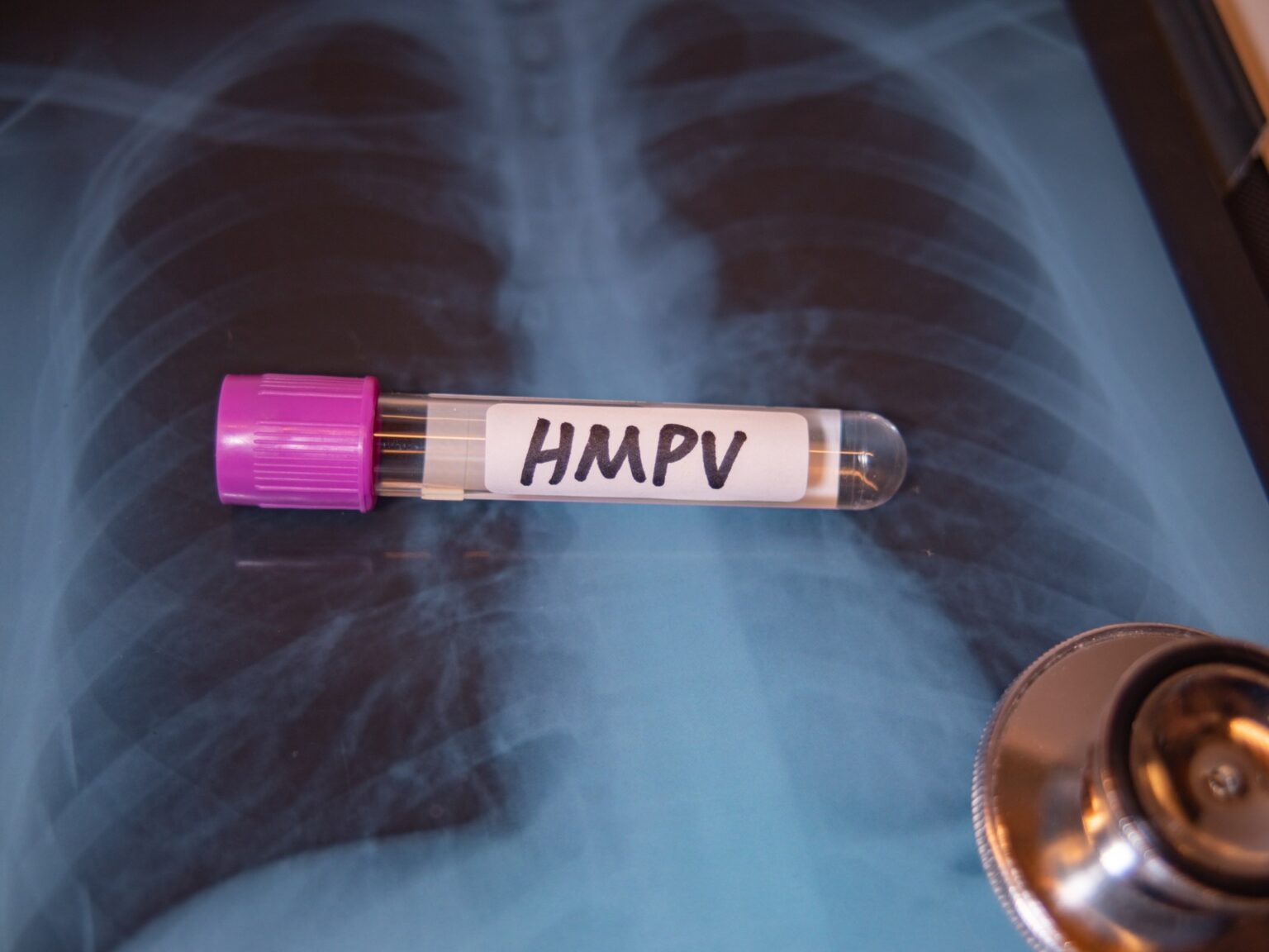 Chinese researcher: Virus infection rate "HMPV" It is declining - Kees